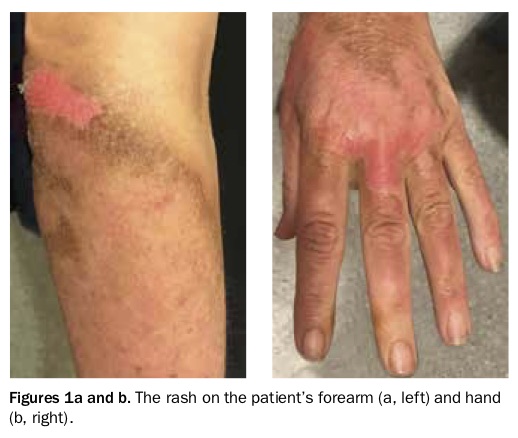 Photoallergic Eruption